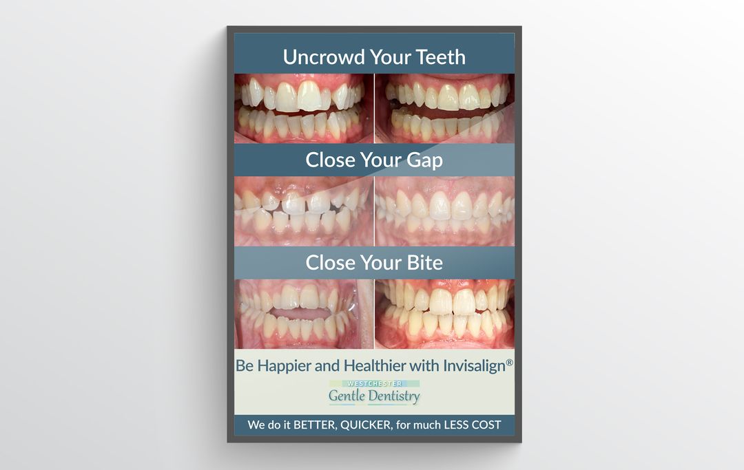 Dental Marketing Ideas: Impactful Invisalign Posters and Materials